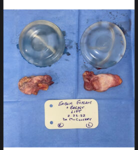 My Explant & Breast Implant Illness Recovery: 1 Week Later - Amanda ...