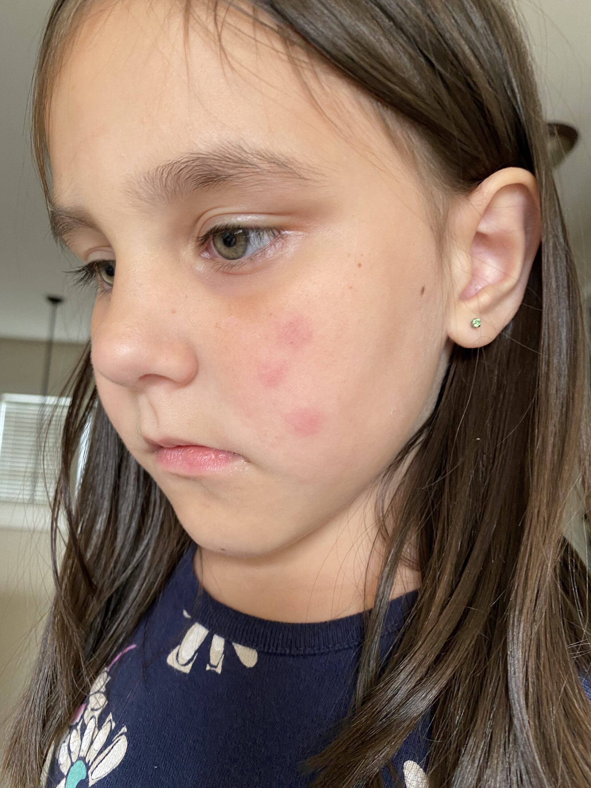 How Our Family Got Rid Of Bed Bugs: Pictures and Treatment - Amanda Seghetti