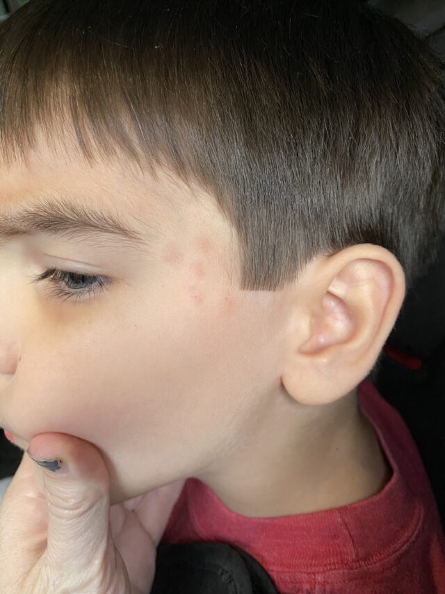 How Our Family Got Rid Of Bed Bugs: Pictures and Treatment - Amanda ...